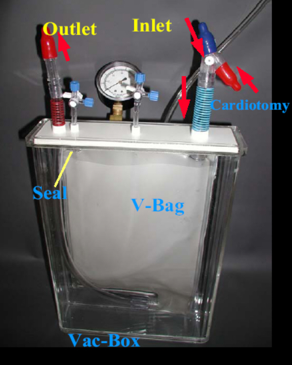Vacuum Assist and the safety of a soft shell reservoir: V-Bag